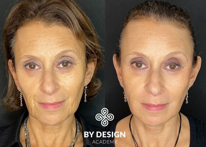 Full Face Transformation | By Design Academy | Injectable Course